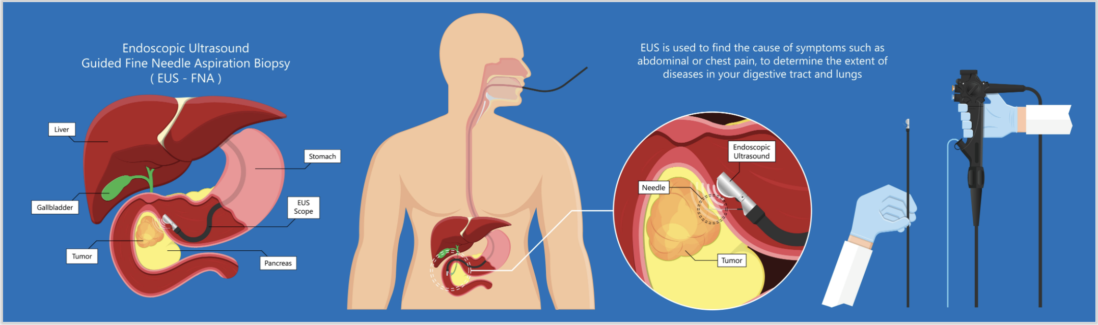 EUS (Endoscopic Ultrasound) – Dr Mathew Keegan