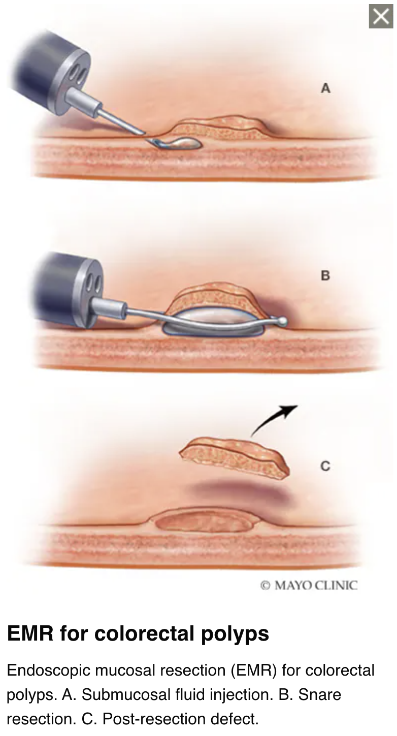 Advanced Endoscopy: EMR and ESD – Dr Mathew Keegan